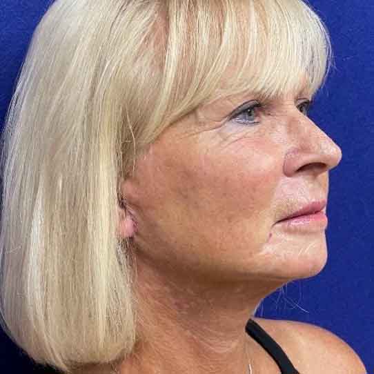 Treating Moles and Other Skin Growths | Skin & Vein Center