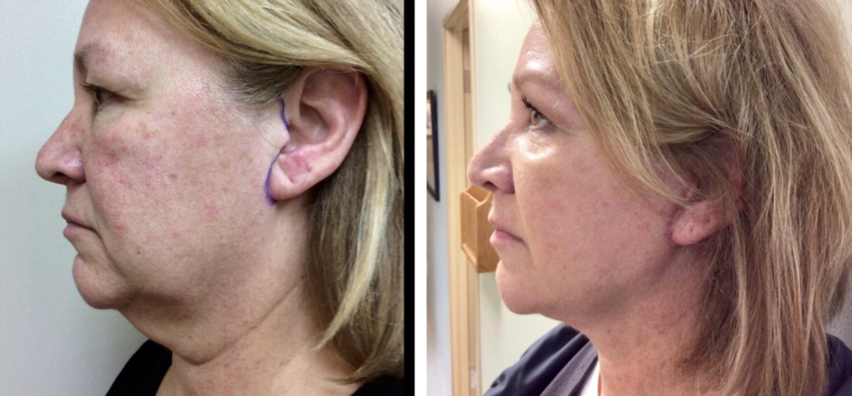 Five Reasons Mini-Lifts are Your Best Option | Skin and Vein