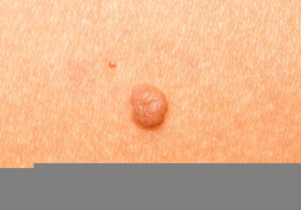Raised Skin Moles