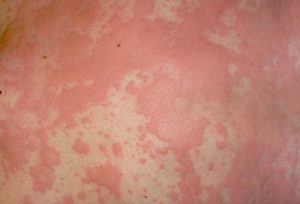 All About Rashes: Descriptions, Treatments & More | Skin & Vein