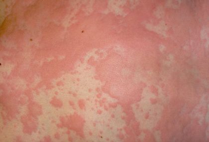 All About Rashes: Descriptions, Treatments & More | Skin & Vein