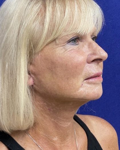 Best Mini Neck Lift Michigan | Skin & Vein Center