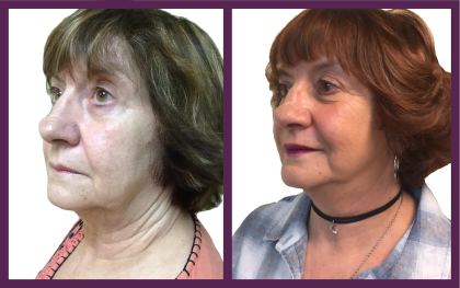 The HourLift Mini-Facelift | Look 10 Years Younger | Benefits and Costs