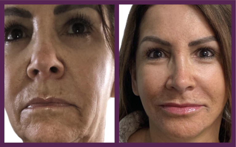 The HourLift Mini-Facelift | Look 10 Years Younger | Benefits and Costs