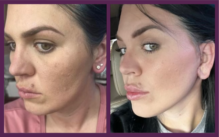 The HourLift Mini-Facelift | Look 10 Years Younger | Benefits and Costs