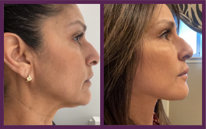 The HourLift Mini-Facelift | Look 10 Years Younger | Benefits and Costs