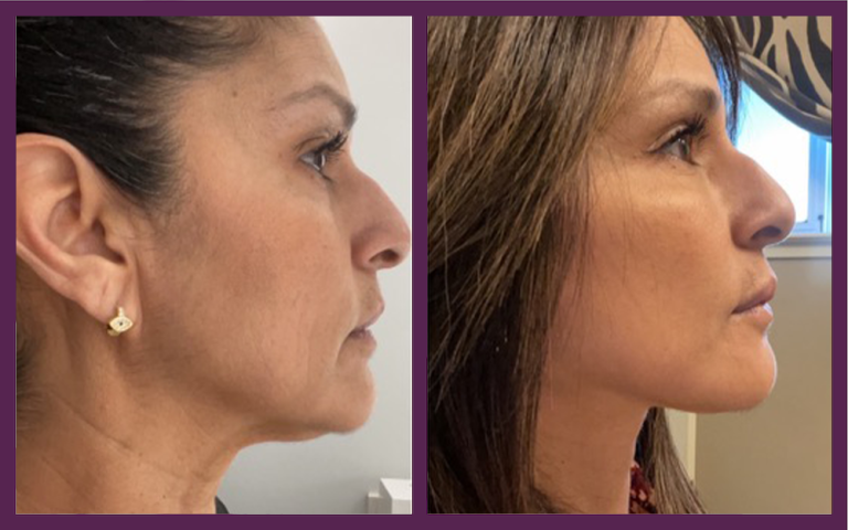 The HourLift Mini-Facelift | Look 10 Years Younger | Benefits and Costs