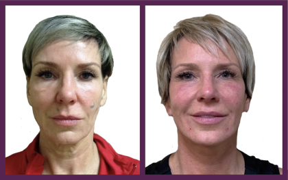 The HourLift Mini-Facelift | Look 10 Years Younger | Benefits and Costs
