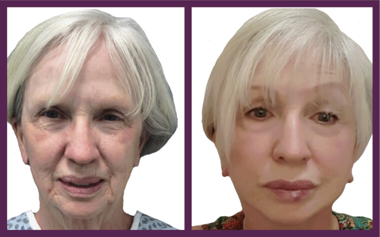 The HourLift Mini-Facelift | Look 10 Years Younger | Benefits and Costs
