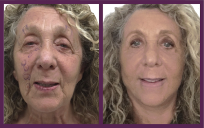 The HourLift Mini-Facelift | Look 10 Years Younger | Benefits and Costs