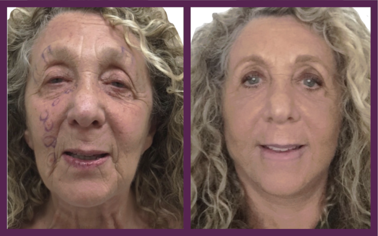 The HourLift Mini-Facelift | Look 10 Years Younger | Benefits and Costs