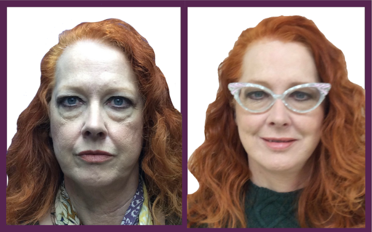 The HourLift Mini-Facelift | Look 10 Years Younger | Benefits and Costs