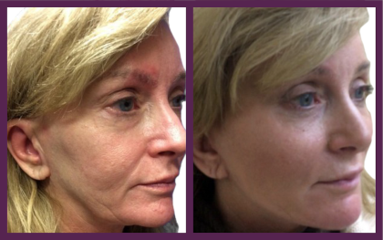 The HourLift Mini-Facelift | Look 10 Years Younger | Benefits and Costs