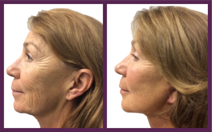 The HourLift Mini-Facelift | Look 10 Years Younger | Benefits and Costs