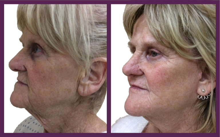 The HourLift Mini-Facelift | Look 10 Years Younger | Benefits and Costs