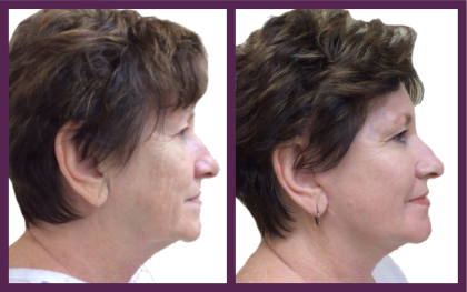 The HourLift Mini-Facelift | Look 10 Years Younger | Benefits and Costs