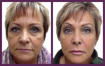 The HourLift Mini-Facelift | Look 10 Years Younger | Benefits and Costs
