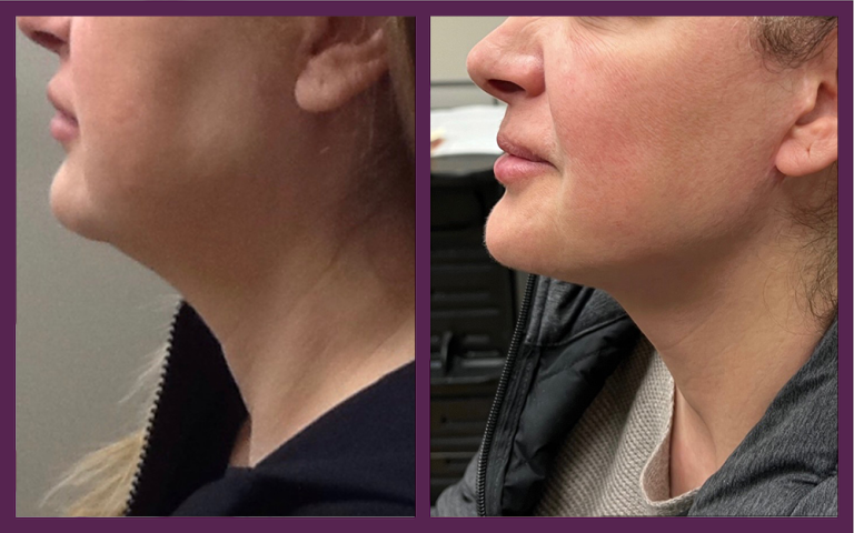 The HourLift Mini-Facelift | Look 10 Years Younger | Benefits and Costs