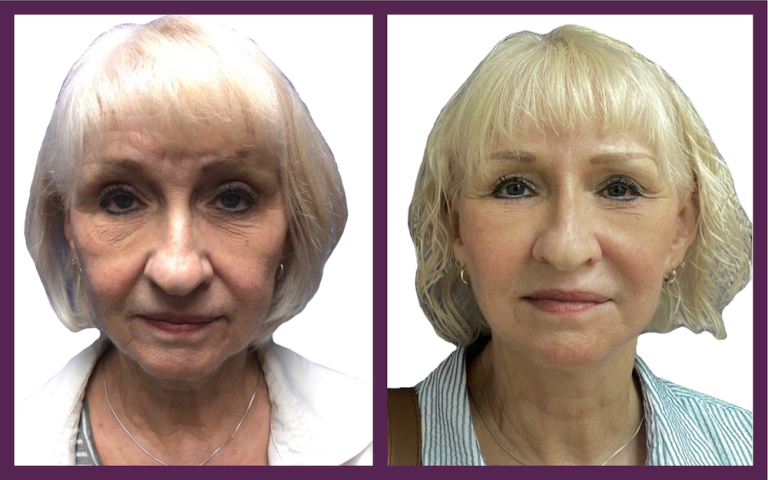 The HourLift Mini-Facelift | Look 10 Years Younger | Benefits and Costs