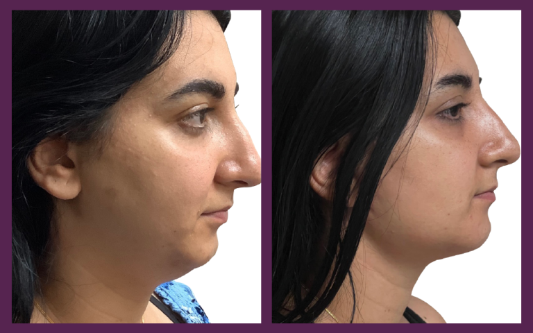 The HourLift Mini-Facelift | Look 10 Years Younger | Benefits and Costs