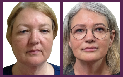 The HourLift Mini-Facelift | Look 10 Years Younger | Benefits and Costs