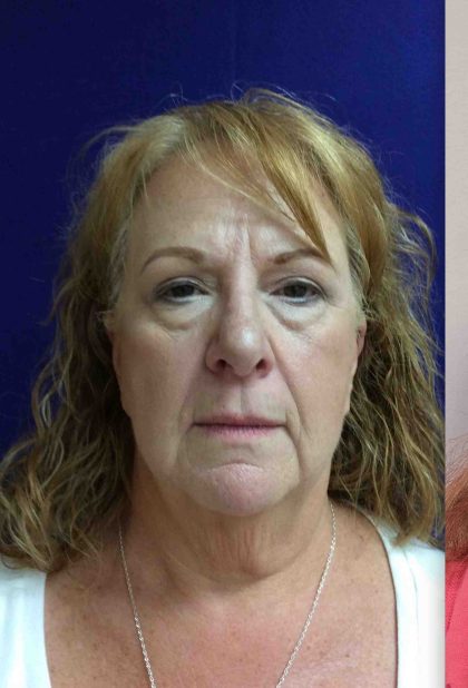 Patient #9199 HourLift Before and After Photos Fenton - Plastic Surgery ...