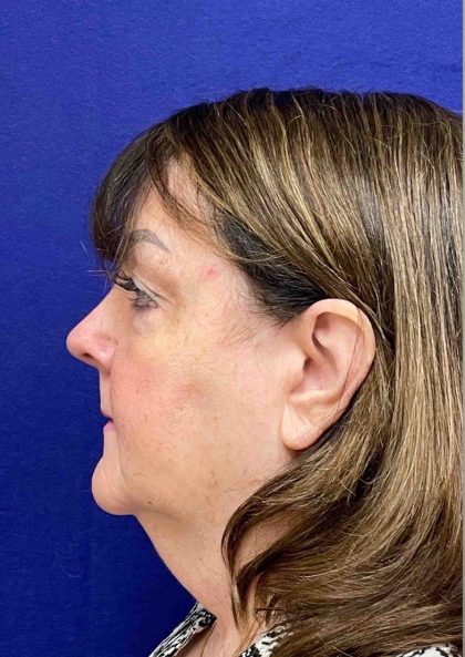 Patient #9194 HourLift Before and After Photos Fenton - Plastic Surgery ...