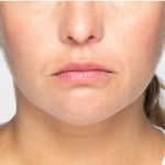 Revanesse Versa - Lips Before and After Photos Fenton - Plastic Surgery ...