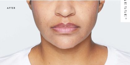 Patient #9238 Revanesse Versa - Lips Before and After Photos Fenton ...