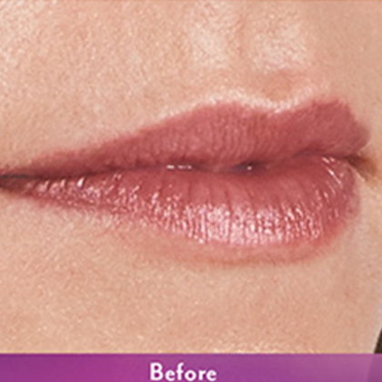 Patient #9983 Volbella Before and After Photos Fenton - Plastic Surgery ...