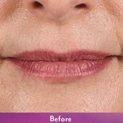 Patient #9973 Volbella Before and After Photos Fenton - Plastic Surgery ...