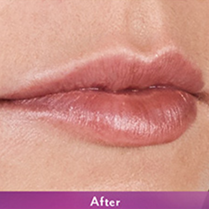 Patient #9983 Volbella Before and After Photos Fenton - Plastic Surgery ...