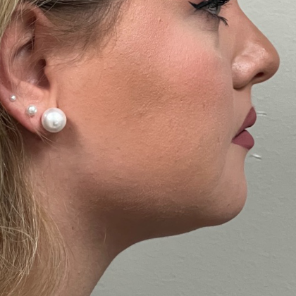 Patient #10392 Revanesse Versa - Cheeks Before and After Photos Fenton ...