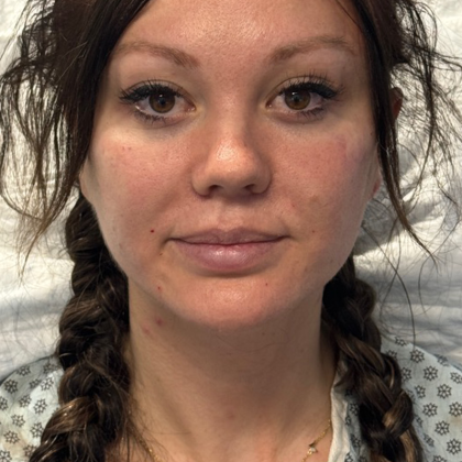 Patient #10660 HourLift Before and After Photos Fenton - Plastic ...