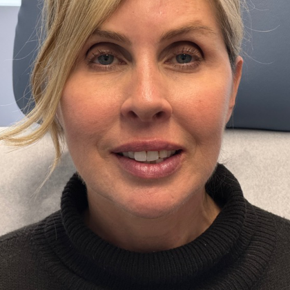 Patient #10743 Midface Filler Before and After Photos Fenton - Plastic ...