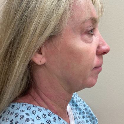 Patient #10802 Mini Facelift Before and After Photos Fenton - Plastic ...