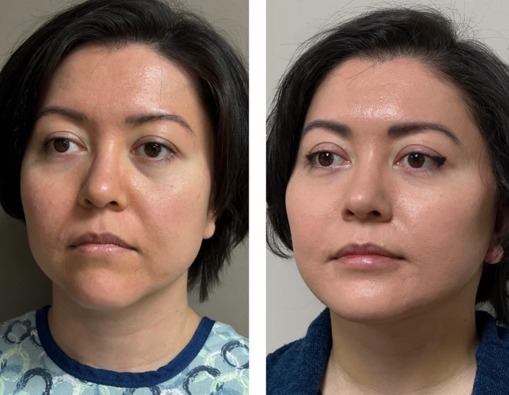 Best Mini Facelift Michigan | Skin & Vein Center