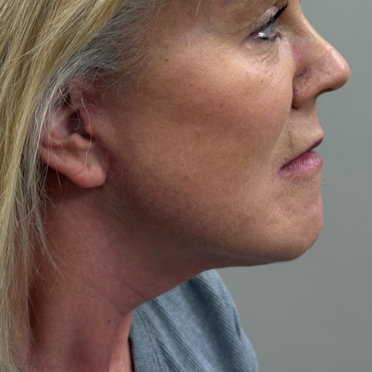 Patient #11155 HourLift Before and After Photos Fenton - Plastic ...